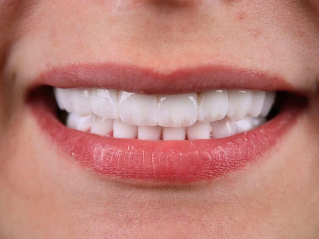 Zirconium Crowns: The Ideal Choice for Dental Restoration - Biusmile